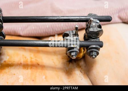 external fixation device on pelvic close up in patient with pelvic ...