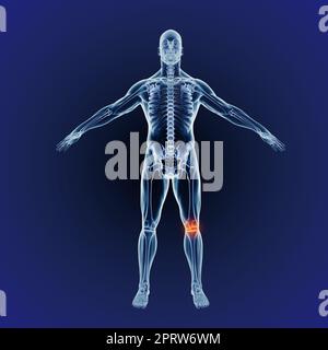 When inflammation strikes. A full length cgi representation of the ...