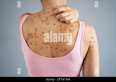 Skin Rash And Itchy Back Acne. Dry Eczema Allergy Stock Photo - Alamy
