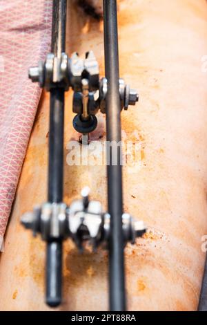 wound in skin from external fixation device on hip close up in patient ...