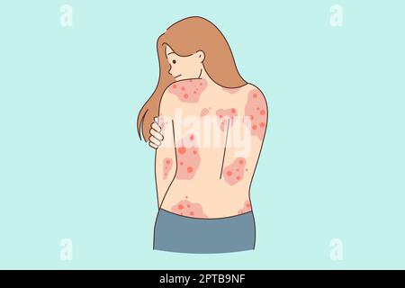 Unhealthy woman showing red rash on back suffer from dermatitis. Unwell ...