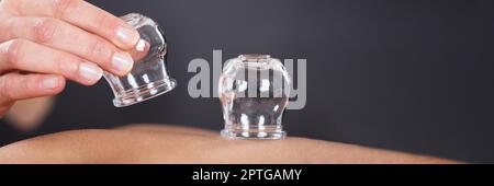 Cupping Therapy Using Vacuum Chinese Glass. Cup Massage Stock Photo - Alamy