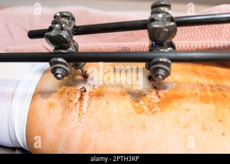 hole in skin from external fixation device on hip close up in patient ...
