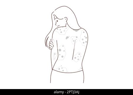 Unhealthy woman showing red rash on back suffer from dermatitis. Unwell ...