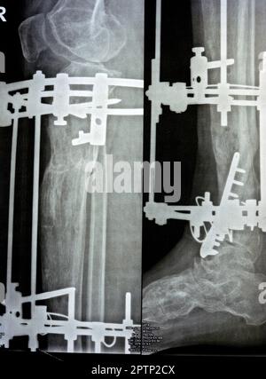 Distal comminuted fracture fibula managed by plate and screws, distal ...