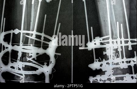 Distal comminuted fracture fibula managed by plate and screws, distal ...