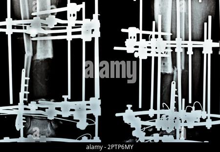 Distal comminuted fracture fibula managed by plate and screws, distal ...