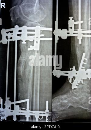 Distal comminuted fracture fibula managed by plate and screws, distal ...