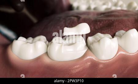 Ceramic Onlay quarter crown over a tooth- 3D Rendering Stock Photo - Alamy