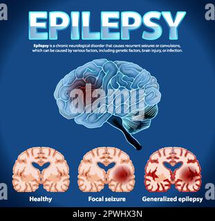 Informative poster of Epilepsy illustration Stock Vector Image & Art ...