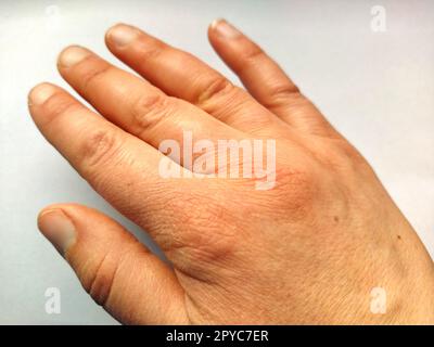 Gout. Close-up of the hand of a patient suffering from gout, showing ...