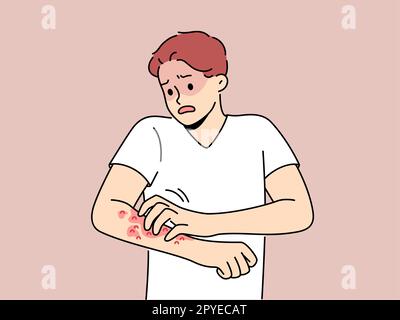 Unhealthy man scratching arm suffer from monkey pox. Unwell guy itch ...