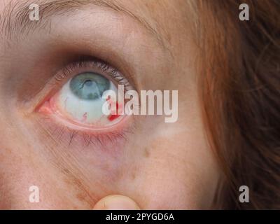 Subconjunctival hemorrhage or subconjunctival bleeding, hyposhagmus ...