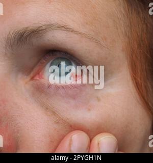 Subconjunctival hemorrhage or subconjunctival bleeding, hyposhagmus ...