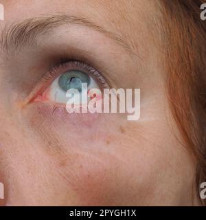 Subconjunctival hemorrhage or subconjunctival bleeding, hyposhagmus ...