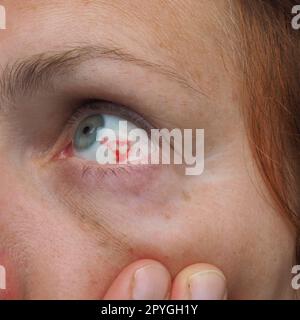 Subconjunctival hemorrhage or subconjunctival bleeding, hyposhagmus ...