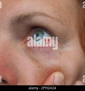 Subconjunctival hemorrhage or subconjunctival bleeding, hyposhagmus ...