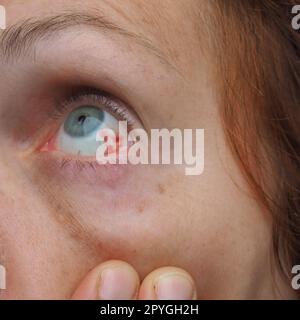 Subconjunctival hemorrhage or subconjunctival bleeding, hyposhagmus ...