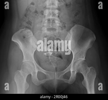 Blocked fallopian tube, X-ray Stock Photo - Alamy