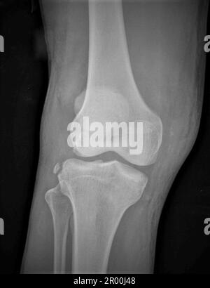 Segond fracture, X-ray Stock Photo - Alamy