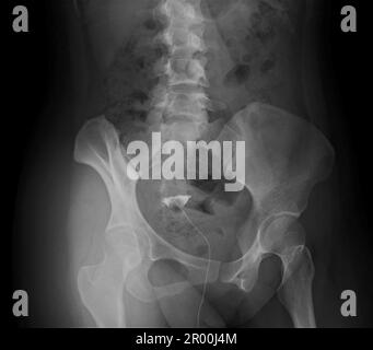 Blocked fallopian tube, X-ray Stock Photo - Alamy