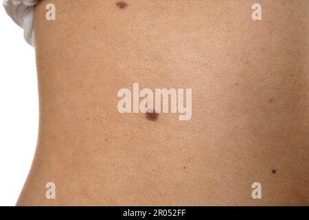Closeup of woman`s body with birthmarks on white background, back view ...