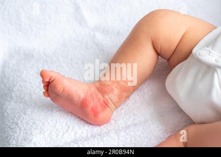 Hemangioma red birthmark on the leg of newborn baby Stock Photo - Alamy