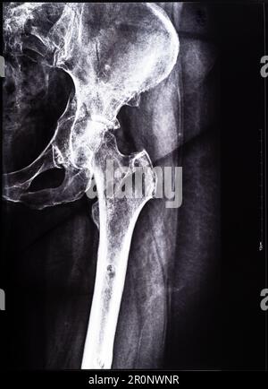 x-ray of junction of tibia and pelvis after healed of fracture of ...