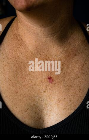 Skin cancer. Ulcerated basal cell carcinoma on a 71-year-old woman's ...