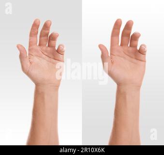 Collage with photos of man showing hands with dry and moisturized skin ...