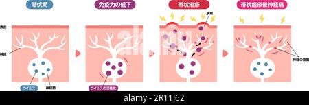 Mechanism of shingles ( herpes zoster ) vector illustration (including ...