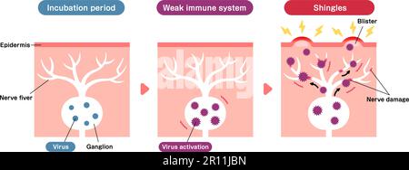 Mechanism of shingles ( herpes zoster ) vector illustration Stock ...