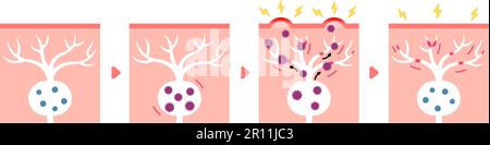 Mechanism of shingles ( herpes zoster ) vector illustration Stock ...