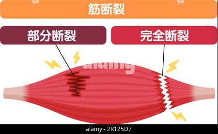 Muscle rupture vector illustration (partial tear Stock Vector Image ...