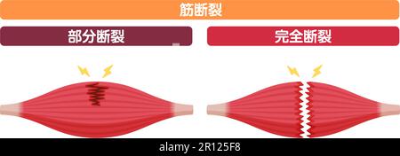Muscle rupture vector illustration (partial and complete tears Stock ...