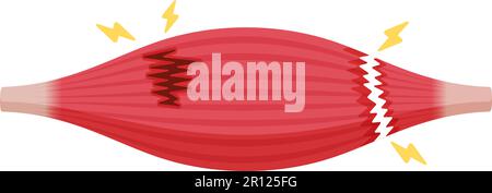 Muscle rupture vector illustration (partial tear Stock Vector Image ...