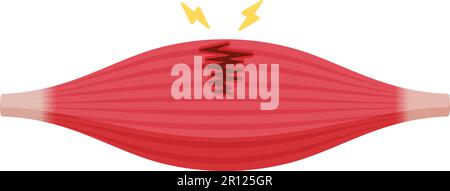 Muscle rupture vector illustration (partial and complete tears Stock ...