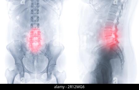 X-ray image of lumbar Spine or L-s spine AP and lateral view for ...