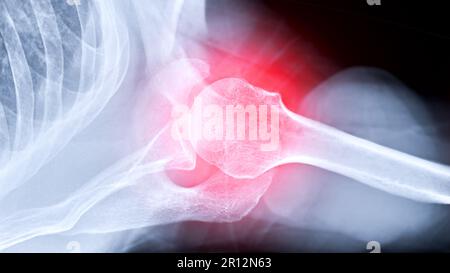 X-ray Shoulder joint shoulder transaxillary view for diagnosis fracture ...