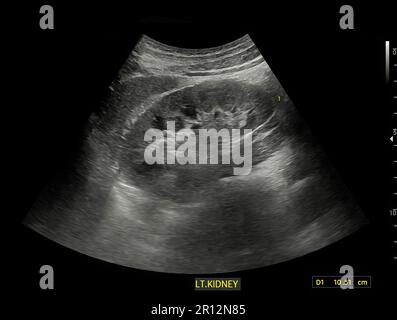 Ultrasound of Kidney or KUB for screening renal stone disease or ...