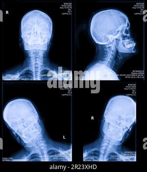 Woman's cervical spine x-ray, human neck radiography Stock Photo - Alamy