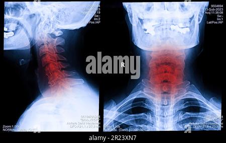Cervical Nerve Roots Radiology