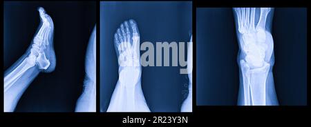 X-ray normal human's foot lateral Stock Photo - Alamy