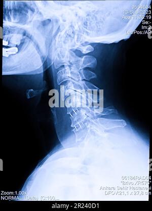 Film xray or radiograph of a cervical neck. AP anterior posterior view ...