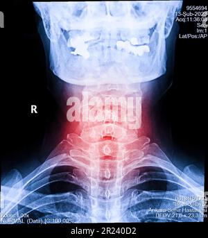 Film xray or radiograph of a cervical neck. AP anterior posterior view ...