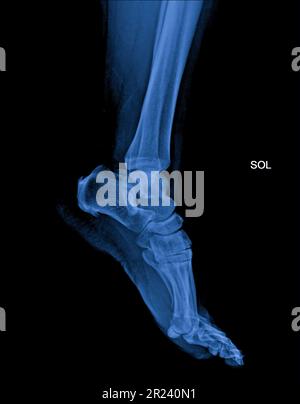 X-ray normal human's foot lateral Stock Photo - Alamy