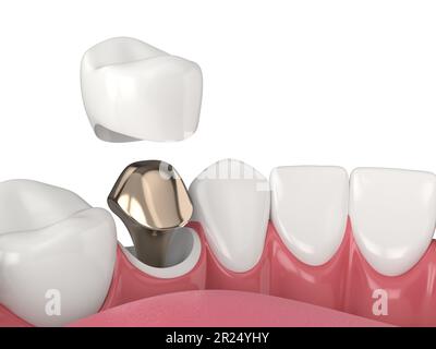 3d render of lower jaw with cast post and core tooth restoration over ...