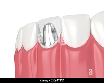 3d render of lower jaw with cast post and core tooth restoration over ...