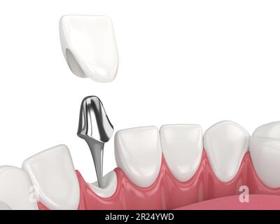 3d render of lower jaw with cast post and core tooth restoration over ...