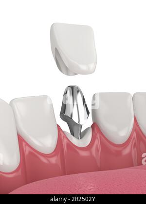 3d render of lower jaw with cast post and core tooth restoration over ...
